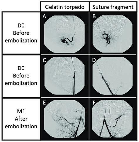 Angiography Controls Before Uterine Embolization A B Just After Download Scientific Diagram