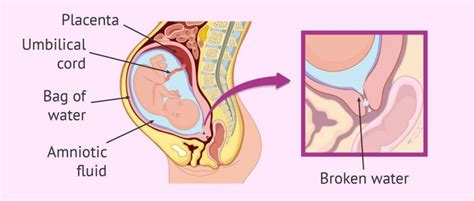 What Is Premature Rupture Of Amniotic Membranes Soheila Ansaripour