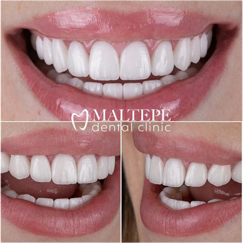 Perfect Teeth Alignment