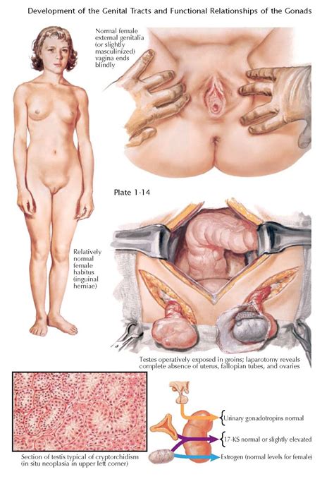Intersex Male Pseudohermaphroditism Ii Hormonal Pediagenosis