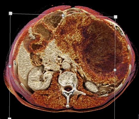Ulcerating Gastric Gist Tumor Stomach Case Studies Ctisus Ct Scanning