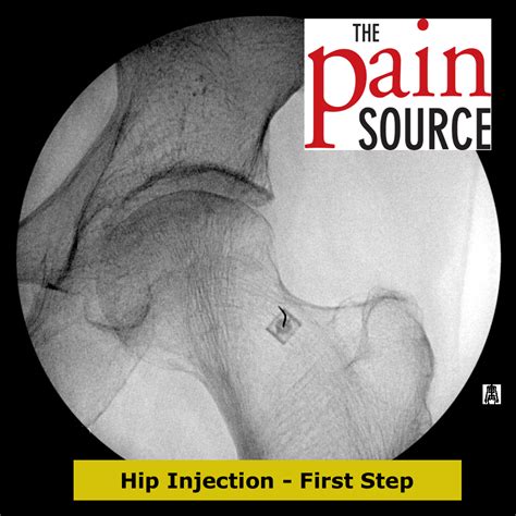 Hip Joint Injection With Fluoroscopy Technique And Tips