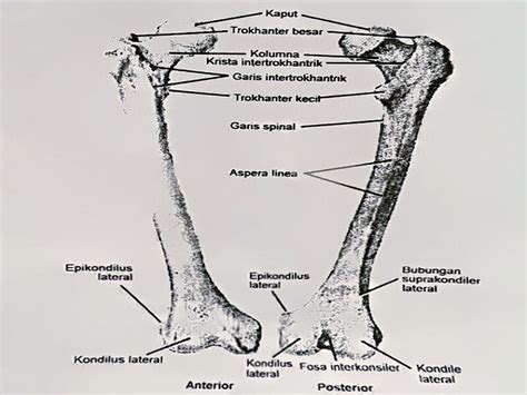 Definisi Fraktur Femur Penyebab Dan Mengobati Fraktur Femur Klinikabar