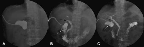 Demonstration Of Images Taken From Cholangiography Via Ptgbd A One Download Scientific Diagram