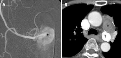 Transarterial Embolization Of Metastatic Mediastinal Hepatocellular Carcinoma