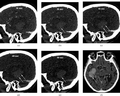 Oblique Sagittal Sections Of The Dynamic Ct Angiography Dcta Sequence Download Scientific