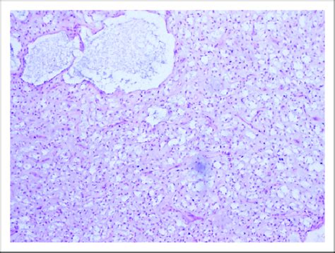 Histological Findings Of Low Grade Myxoid Liposarcoma Hande Original