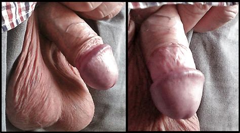 My Penis With Foreskin Remove 1 Pics Xhamster