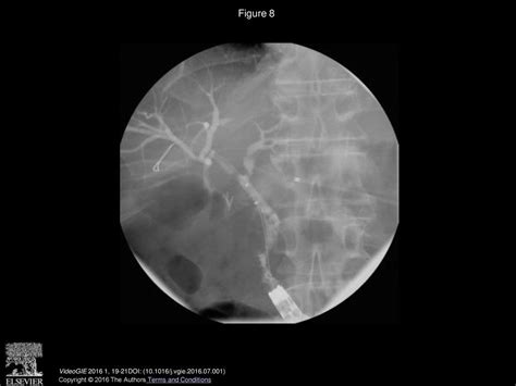 Ercp Through A Gastrojejunal Lumen Apposing Stent Ppt Download