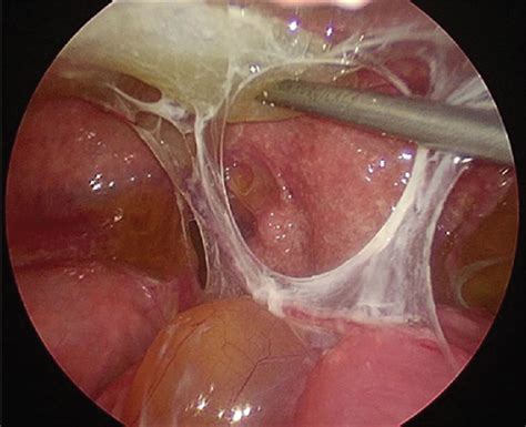 Adnexal Mass With Ascites And High Cancer Antigen 125 In A Young Female Not Always Malignancy
