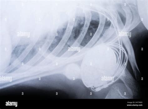 X Ray Imagefrom The Human Chest And Pacemaker Stock Photo Alamy