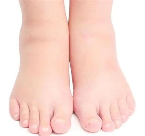 水肿应该如何治疗 再造人