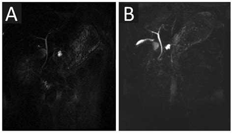 Magnetic Resonance Cholangiopancreatography Comparison Of Two And