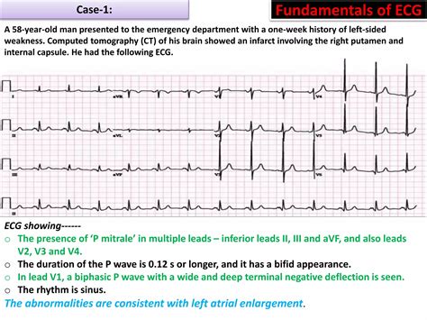 P Wave Abnormalities In Ecg Ppsx