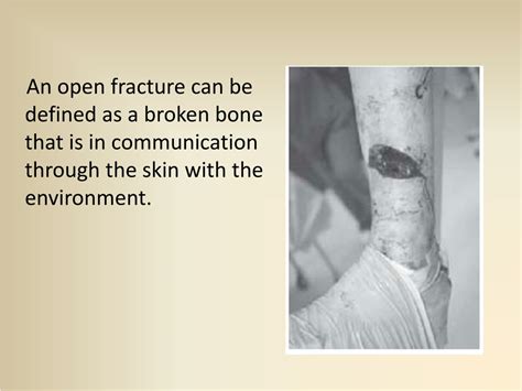 Ppt Open Compound Fractures Powerpoint Presentation Free Download