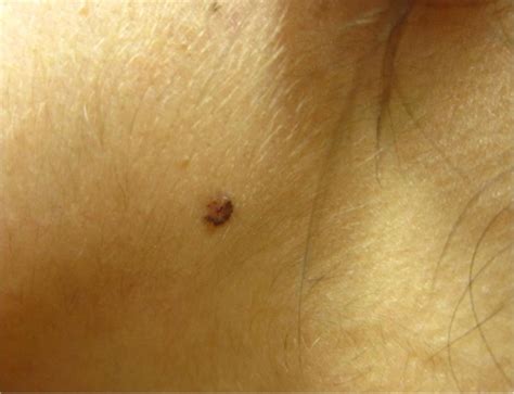 Recurrent Nevus Seen 6 Months After Surgical Excision Download Scientific Diagram