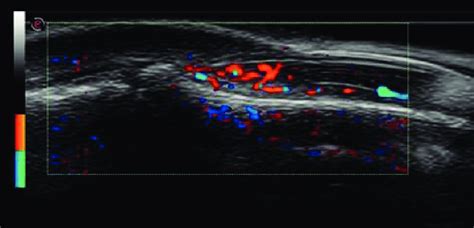 Dorsal Longitudinal Scan Of The Distal Interphalangeal Joint And The Download Scientific