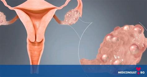 Синдром на поликистозни яйчници — Medconsult Bg