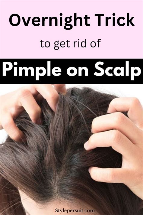 How To Get Rid Of Pimple On Scalp Stylepersuit