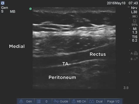 Anesthesia Field Block Tap