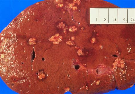 Specimen Of Human Liver With Aspergillosis By Science Photo Library
