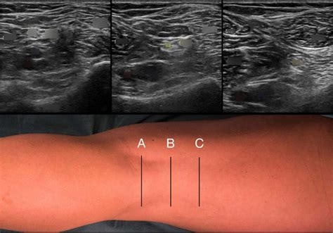 Popliteal Sciatic Block Diagram Quizlet