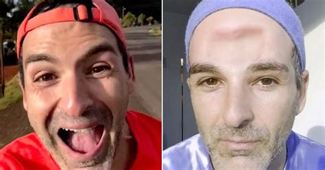 Man Left With Huge Dent In Middle Of Face After Doctors Remove His Forehead The Mirror Us