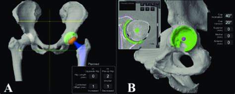 The 3d Preoperative Model Based On Patients Ct Data On Panel A Download Scientific Diagram