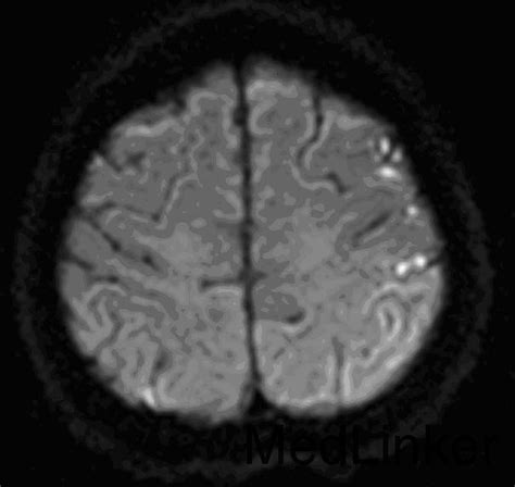 脑膜炎还是脑膜癌？ 医联