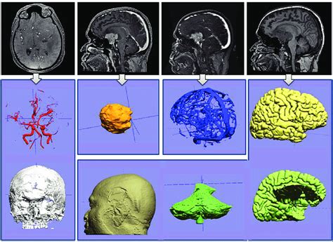 Generation Of 3d Surfaces Of Tumor Cerebral Cortex Brainstem Download Scientific Diagram