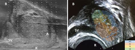 Comparison Of Transperineal Versus Transrectal Prostate Biopsy Download Scientific Diagram