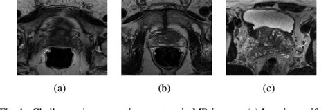 Figure 1 From Deeply Supervised Cnn For Prostate Segmentation