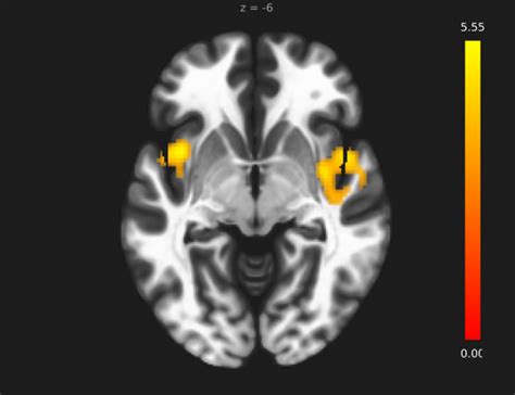 Areas Of Increased Functional Connectivity With The Left Anterior Download Scientific Diagram