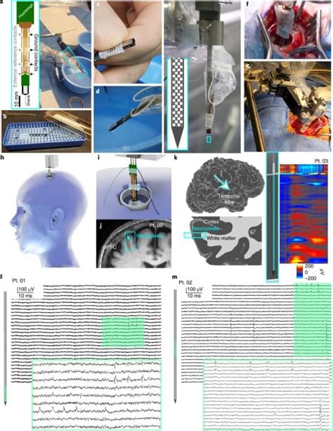 Large Scale Neural Recordings With Single Neuron Resolution Using Neuropixels Probes In Human