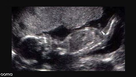 اشتباه سونوگرافی در تشخیص جنسیت جنین دختر سلامت بانوان اوما