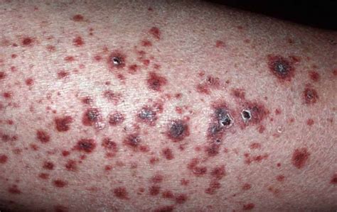 Polyarteritis Nodosa Causes Symptoms Diagnosis Treatment And Survival