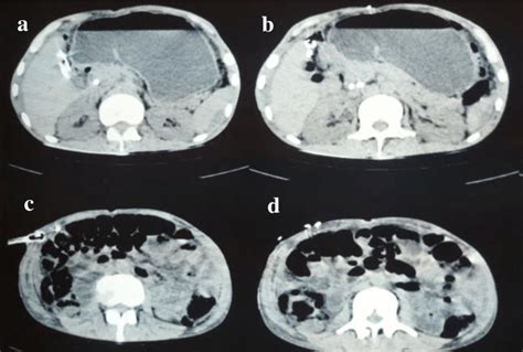A D Post Operative T Tube Cholangiogram Download Scientific Diagram