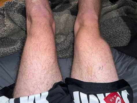 How Bad Is Muscle Atrophy Honestly R ACL