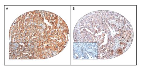 Pd L1 Immunohistochemical Staining In Endometrial Cancer Tissue Download Scientific Diagram