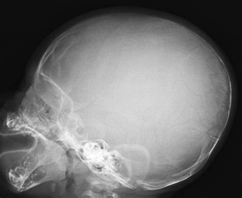 Imaging Spectrum Of Calvarial Abnormalities Radiographics