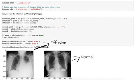Spotting Anomalies In Chest X Ray Scans Using Deep Learning By Adhithia Analytics Vidhya