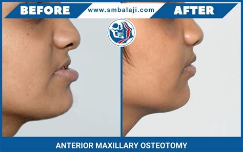 Anterior Maxillary Osteotomy A Surgical Solution For Upper Jaw Prognathism