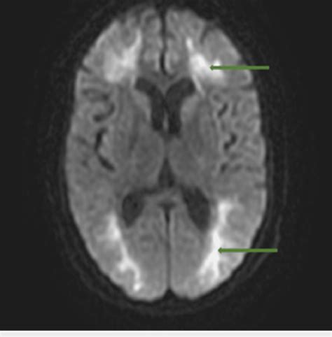 Magnetic Resonance Imaging Mri Ax Dwi Showing Diffuse Bilateral