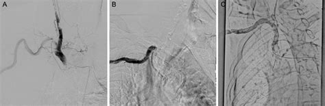 Figure2angiographic Findings Of Subclavian Artery Occlusion A Shows Download Scientific