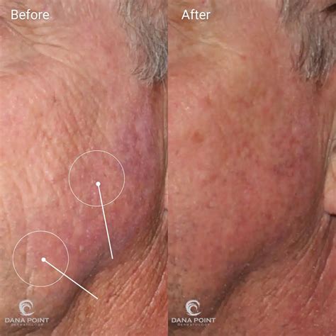 Ablative Fractionated Co2 Laser Resurfacing Men Before And After