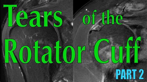 Understanding Rotator Cuff Tears A Comprehensive Guide To Mri