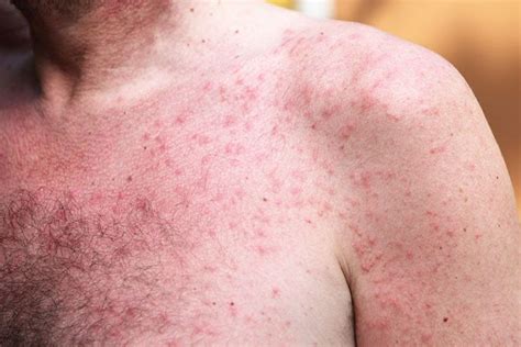 Heat Rash Causes Symptoms Treatment And Prevention