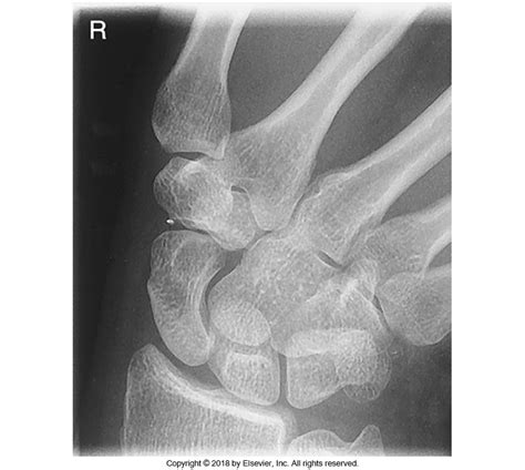 Schapoid Navicular Diagram Quizlet