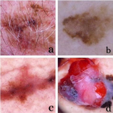 [论文审查] Using Computer Vision For Skin Disease Diagnosis In Bangladesh Enhancing Interpretability