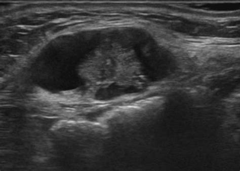 Head And Neck 4 1 Thyroid Gland Case 4 1 3 Thyroid Malignant Lesions Ultrasound Cases